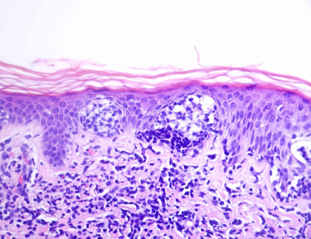 DermpathPro — CASE 4621 - Pennsylvania Specialty Pathology